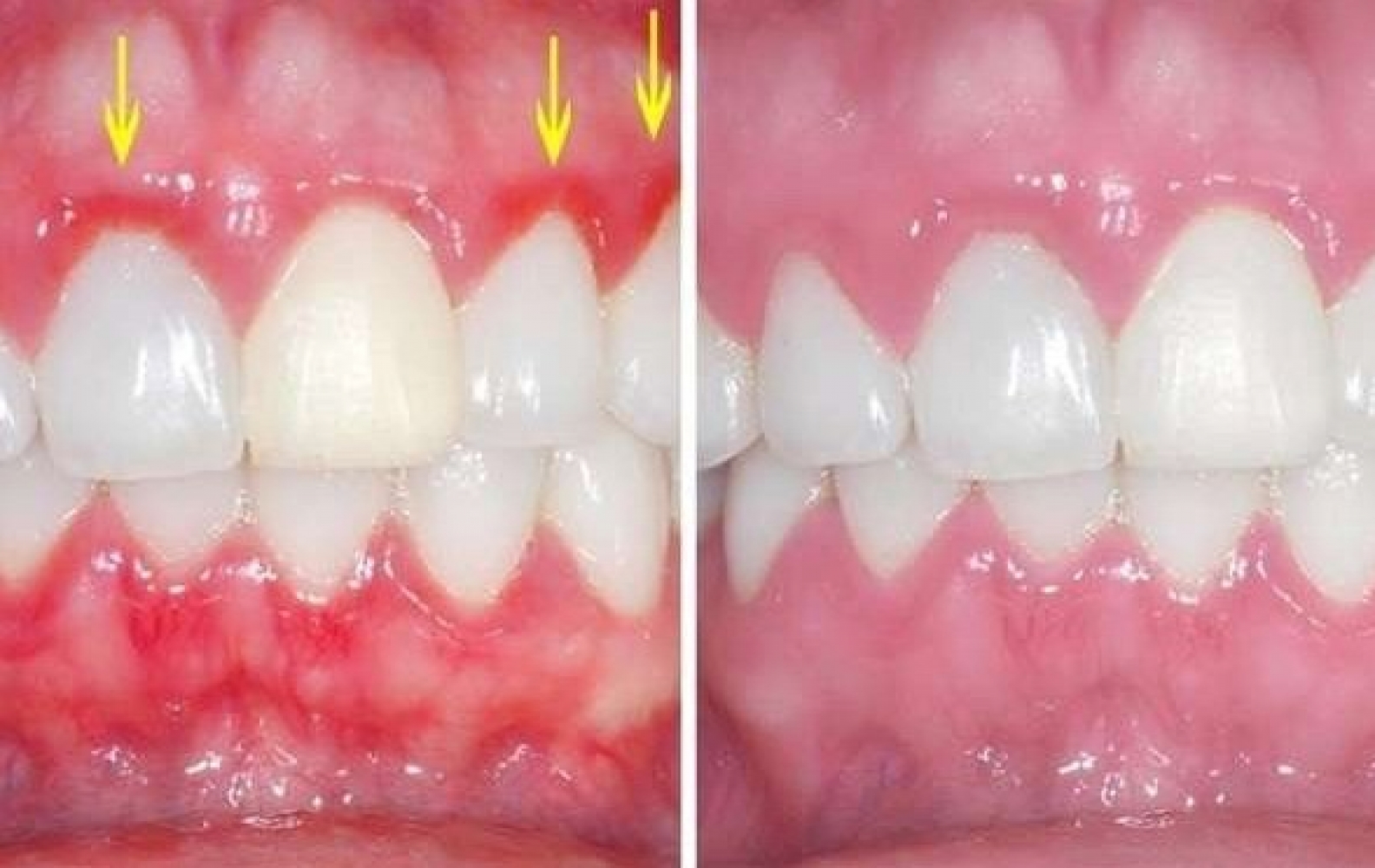 Gengivite: Sinais de Alerta e Tratamento - Sanident - Clínica Dentária